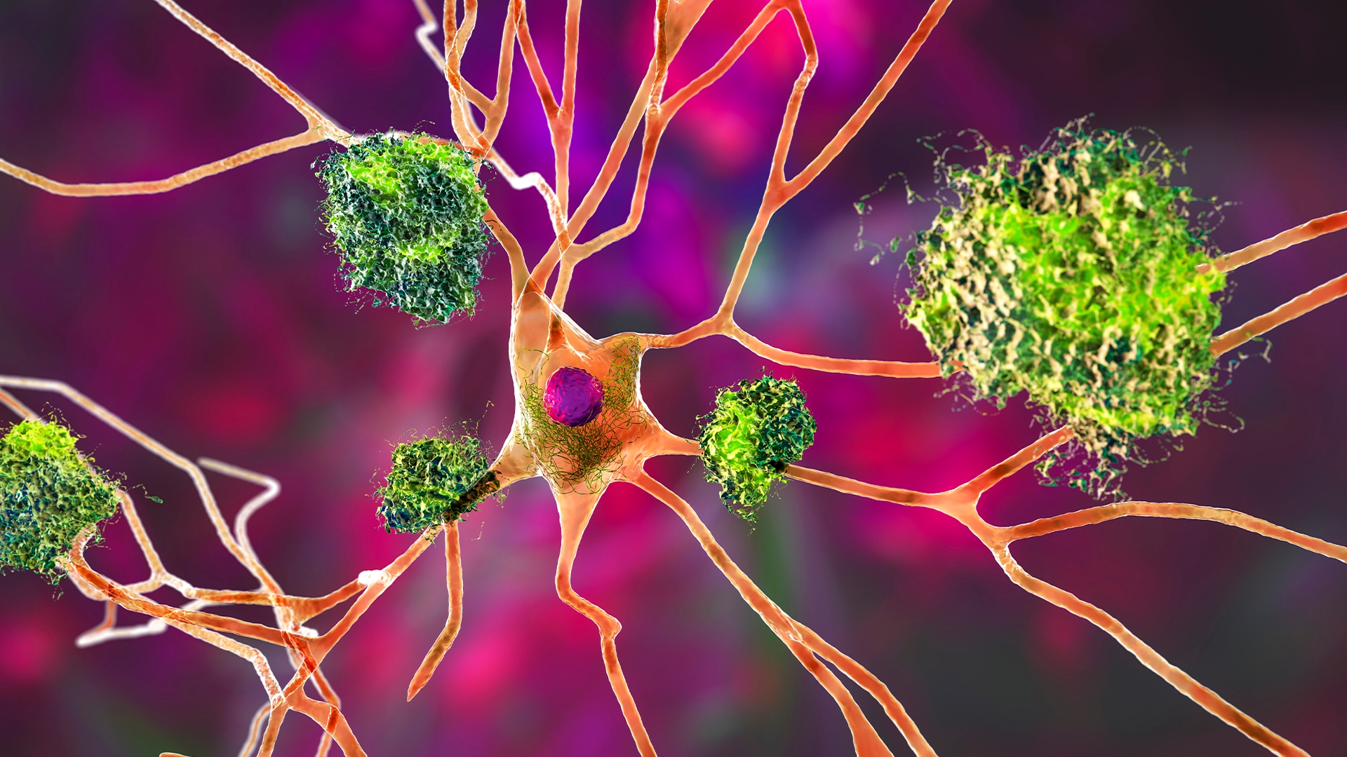 Advancing therapeutic strategies for CSF1R-ALSP | Revvity