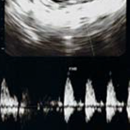 Pre-eclampsia screening - Parents' Guide | Revvity